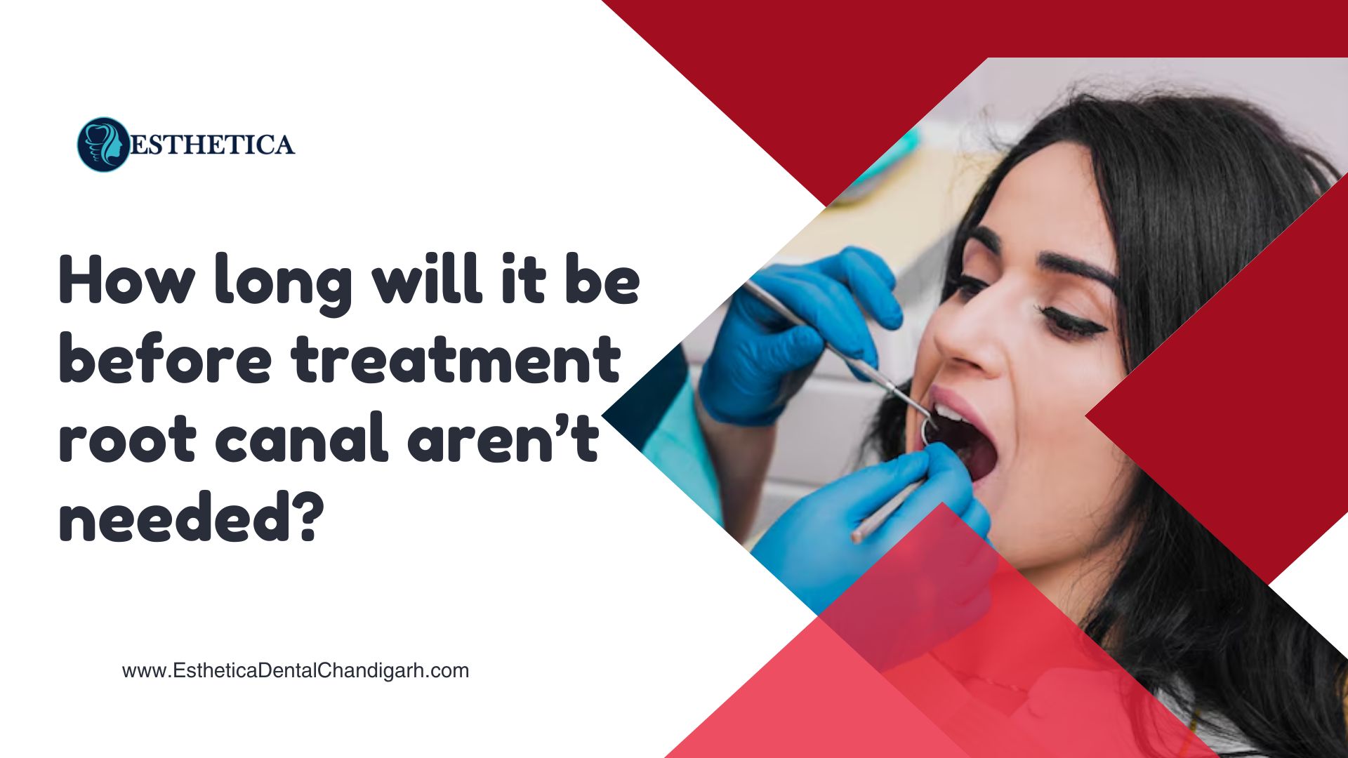 How long will it be before treatment root canal aren't needed?