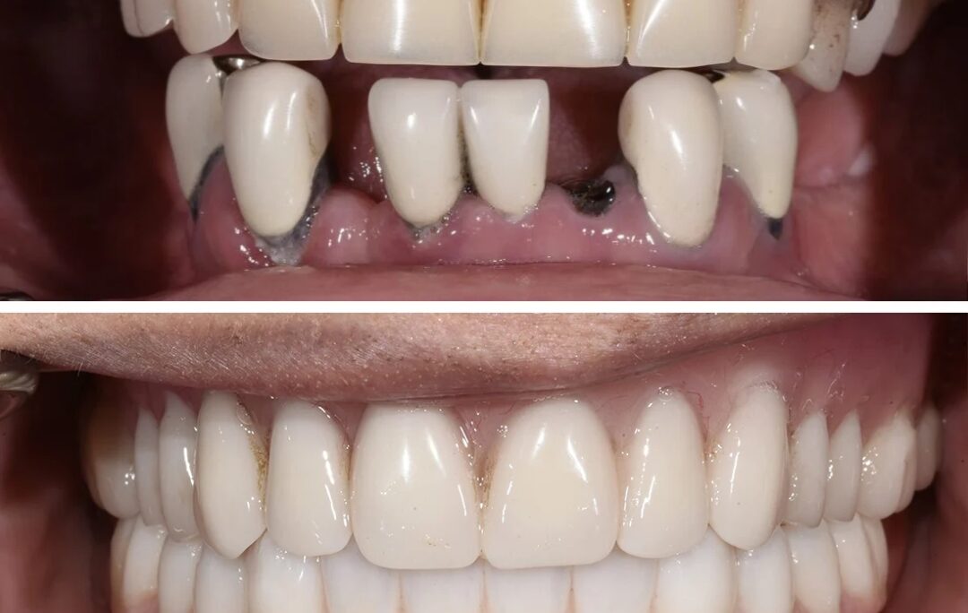 All on 4 Dental Implants Before and After Results | Esthetic Dental