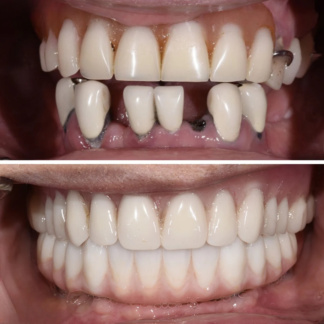All on 4 Dental Implants Before and After Results | Esthetic Dental