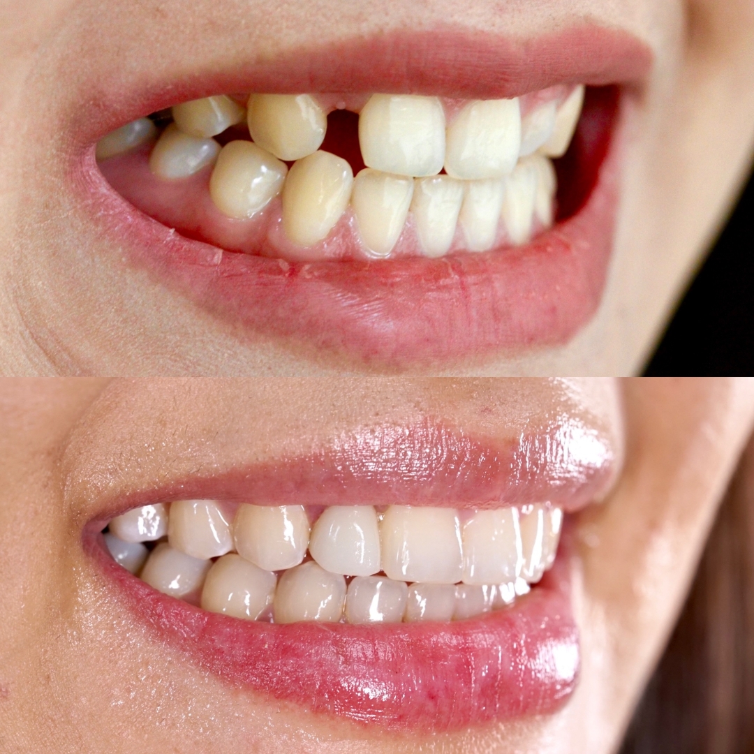 All on 4 Dental Implants Before and After Results | Esthetic Dental